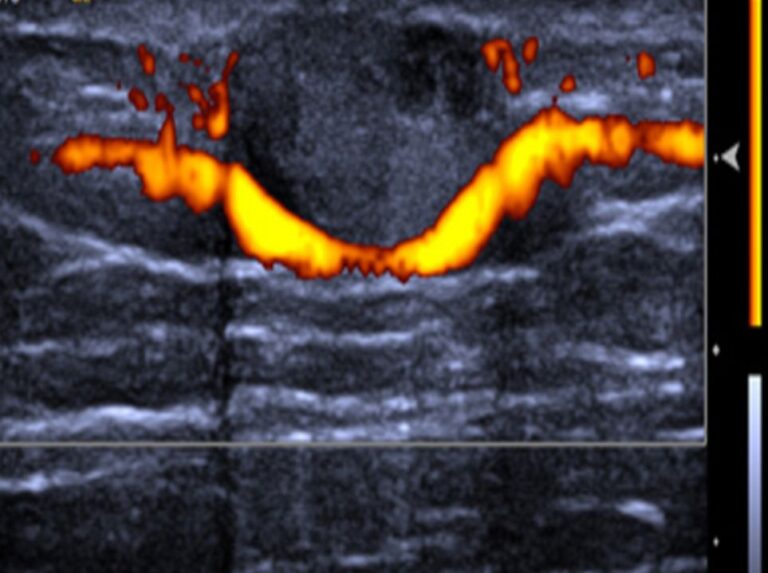 Learn the basics of ultrasound - Cutaneous